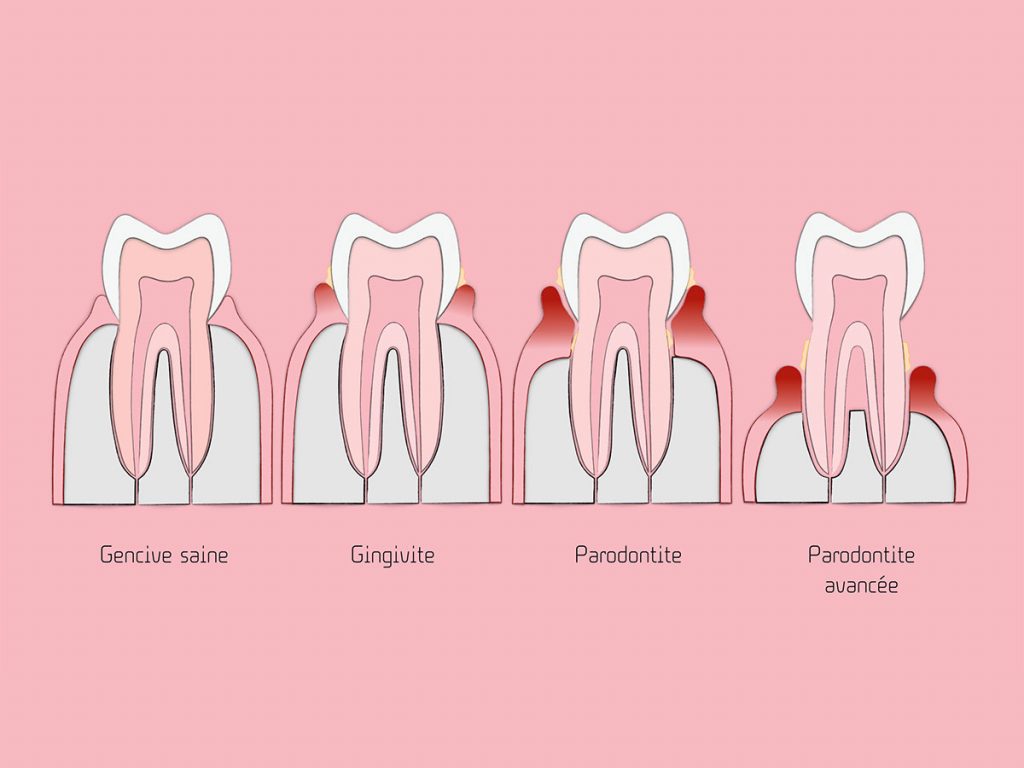 Poches parodontales : Symptômes et traitement | Le Studio Paro